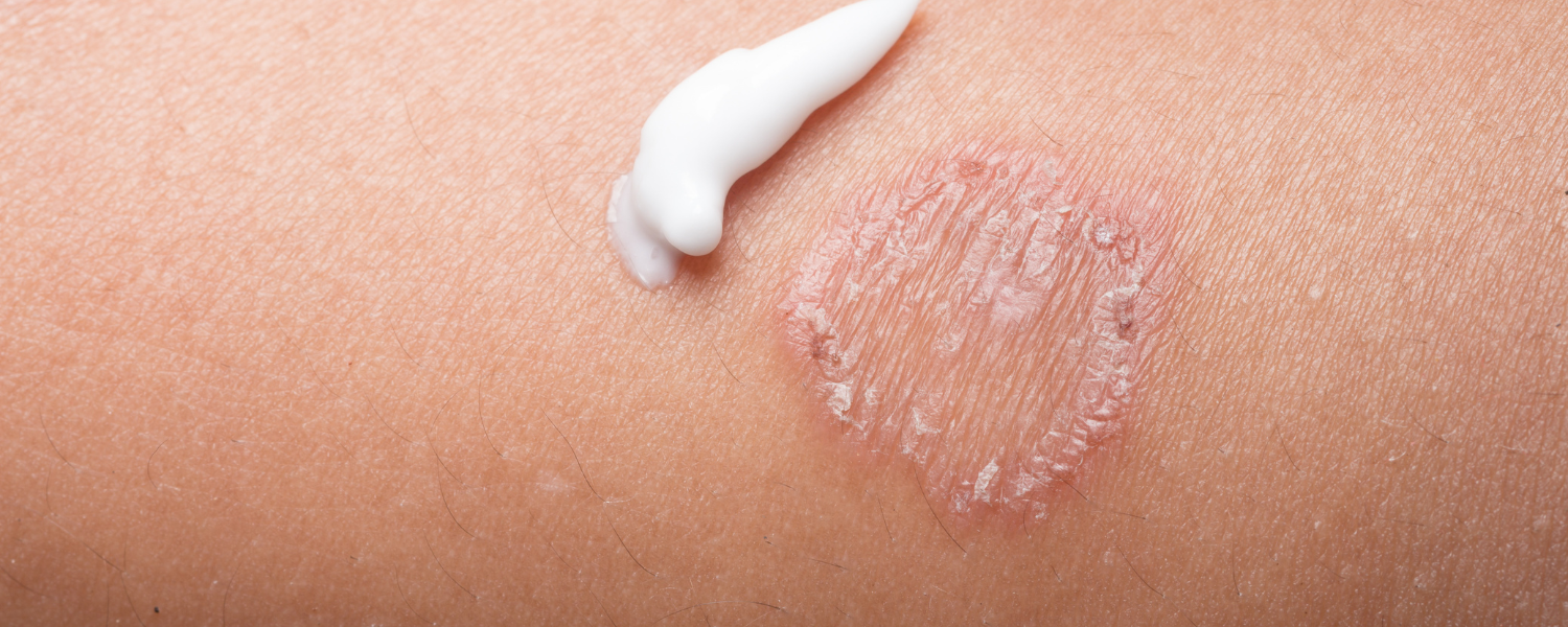 Nummuläres Ekzem - Symptome, Auslöser und Behandlung