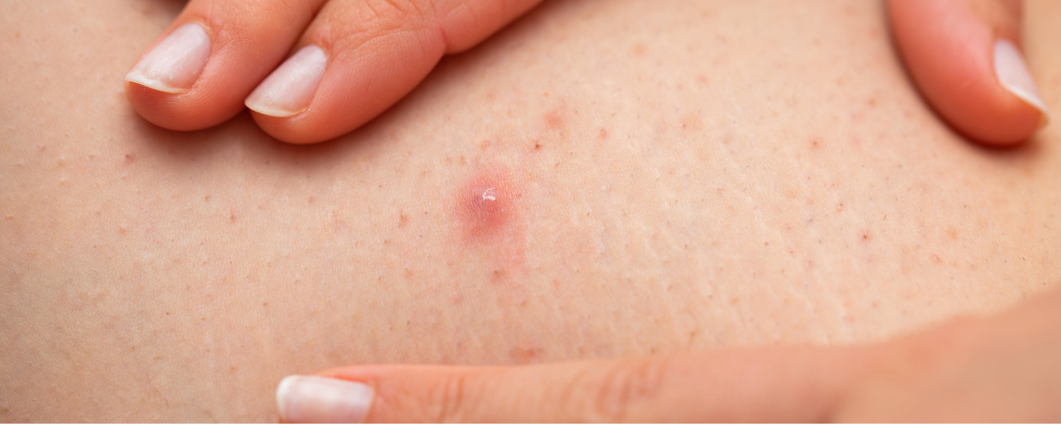 Juckreiz und Ausschlag im Intimbereich? Diese Anzeichen dürfen Sie ...