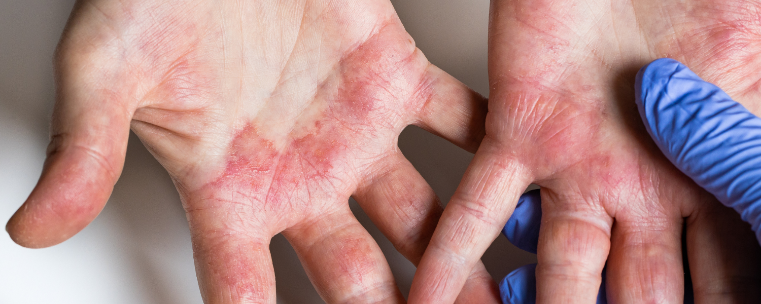Kontaktdermatitis - Symptome, Auslöser und Behandlung