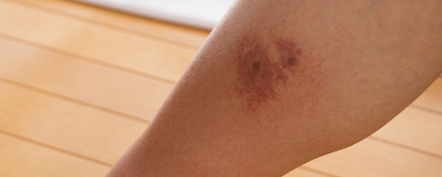 Phlegmone - Alles über Symptome, Ursachen und Behandlung