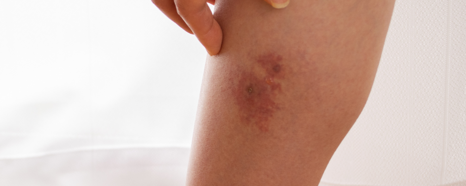 Phlegmone - Alles über Symptome, Ursachen und Behandlung